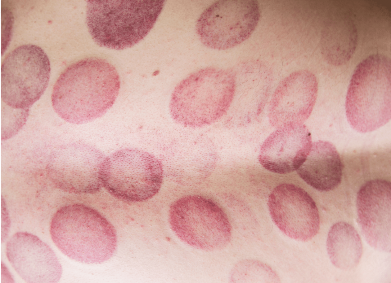 The Benefits of Cupping Massage: Exploring Cupping Marks - Onyeka ...