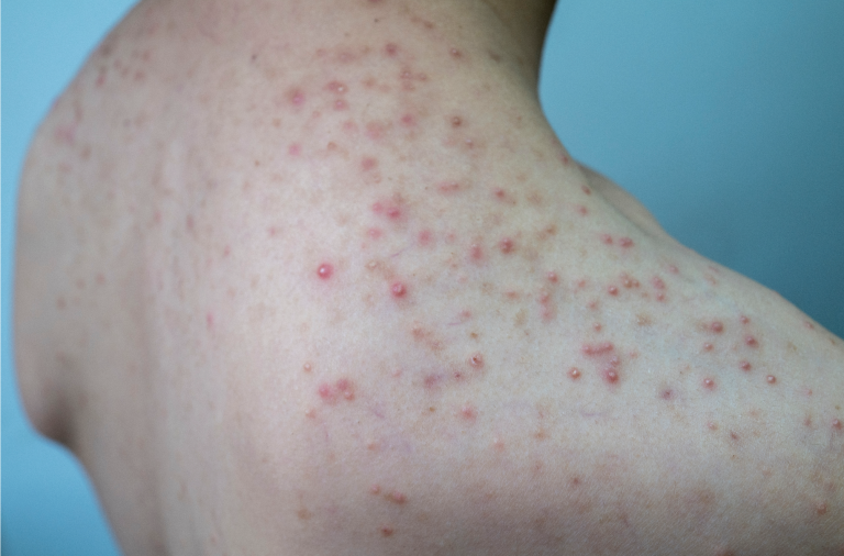 Fungal Folliculitis: Understanding and Treating It from an Esthetics ...